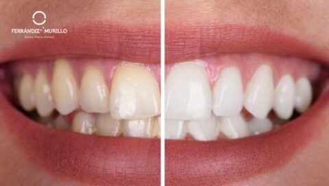 ᐅ Cómo tener la Sonrisa Perfecta Guía en 6 pasos